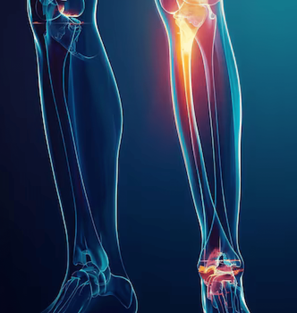 Votre formation en détail ... - Les tendinopathies du membre inférieur